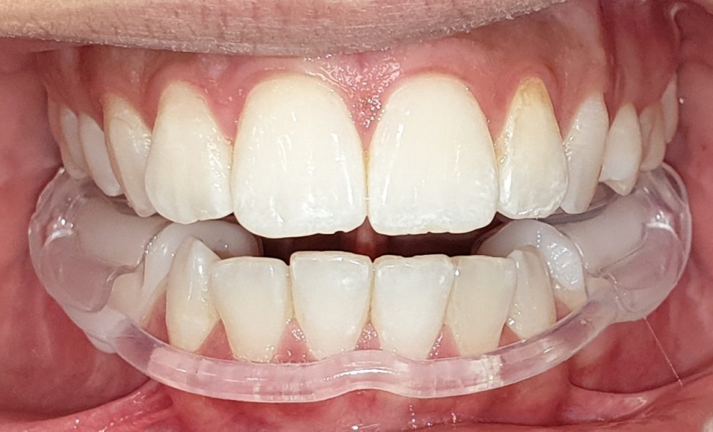 AquaSplint thermo CMD-Aufbissschiene | Snorflex®